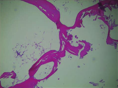 Bone Marrow Biopsy At The Time Of The First Diagnosis Showed Severe
