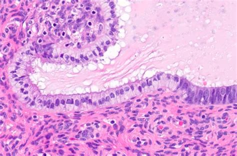 Pathology Outlines Endometrial Metaplasia