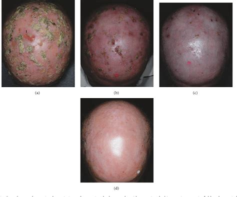 Figure 1 From Sustained Regression Of Hydroxycarbamide Induced Actinic