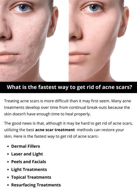 Ppt What Is The Fastest Way To Get Rid Of Acne Scars Powerpoint
