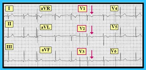 Ecg Interpretation Ecg Interpretation Review 5 T Wave Inversion