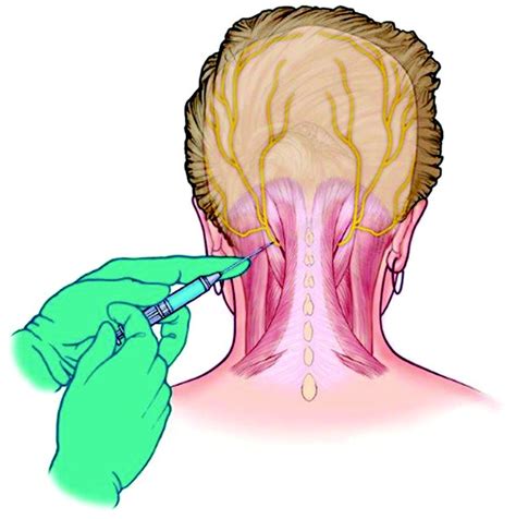 Greater Occipital Nerve