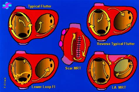 contemporary management of atrial flutter circulation