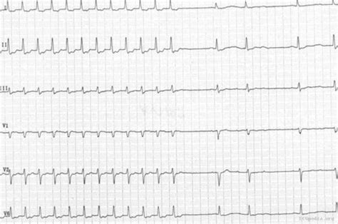 Avnrt Ecgpedia