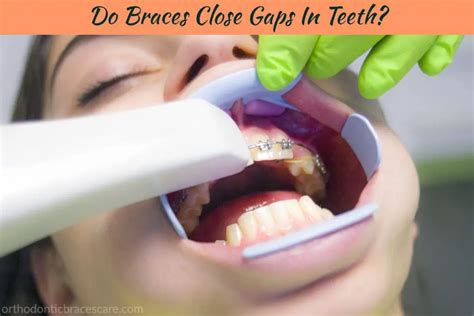 Closing Gaps In Teeth With Braces How Long Does It Take Orthodontic