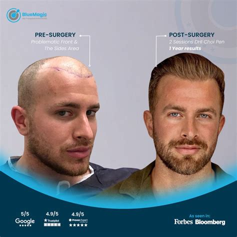 Bluemagic Group Clinic Elevates Hair Transplant Standards With New