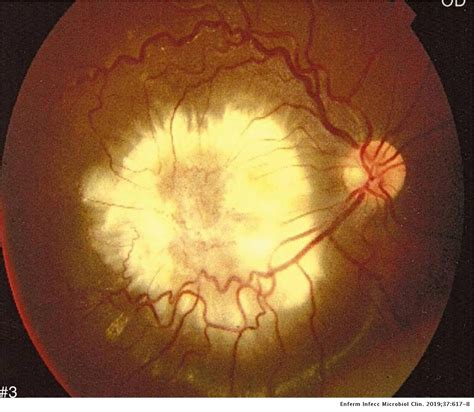 Ocular Toxocariasis In A Pediatric Patient Undergoing A Bone Marrow