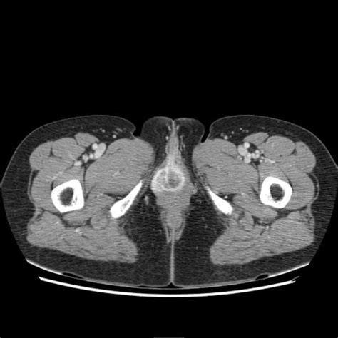 Enhanced Pelvic Ct Scan Demonstrates A Heterogeneously Enhanced Mass On