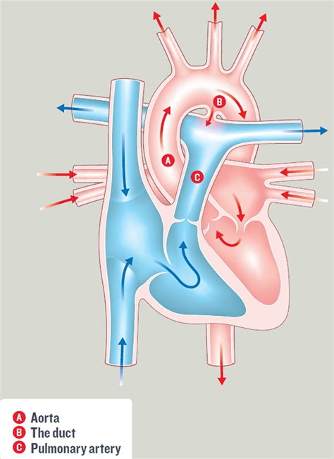 Patent Ductus Arteriosus Signs And Symptoms