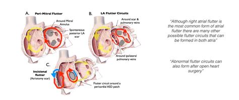 atrial flutter ablation melbourne heart rhythm