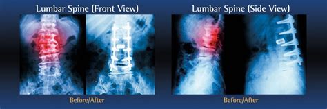 Treatments Spinal Fusion Kansas Spine And Specialty Hospital