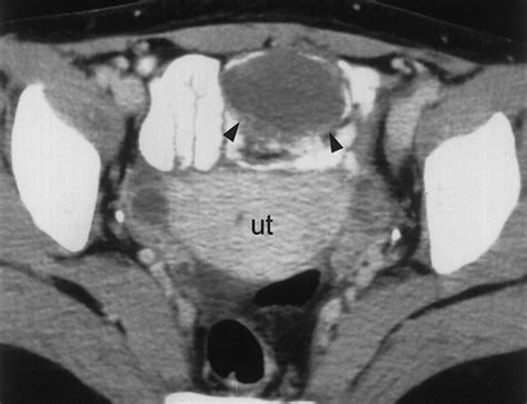 Urachal Remnant Diseases Spectrum Of Ct And Us Findings Radiographics
