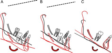 Mandibular Rotation Revisited What Makes It So Important Seminars