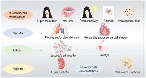 Main Clinical Manifestations Of Systemic Lupus Erythematosus Systemic