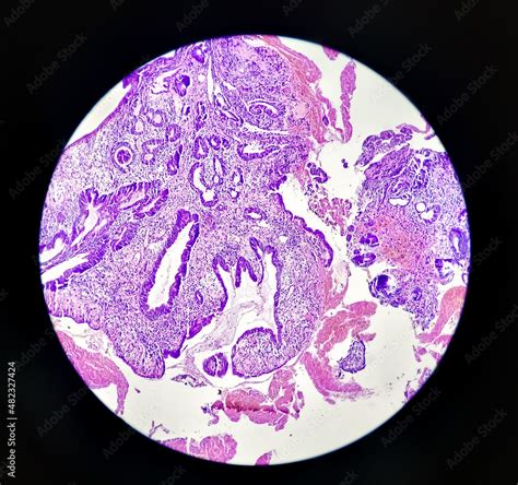 Microscopic Image Torsion Of Testicles Disease Of Male Genital Organs