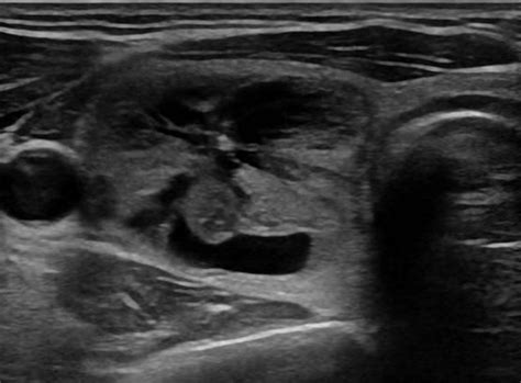 Head And Neck 4 1 Thyroid Gland Case 4 1 2 Thyroid Benign Lesions