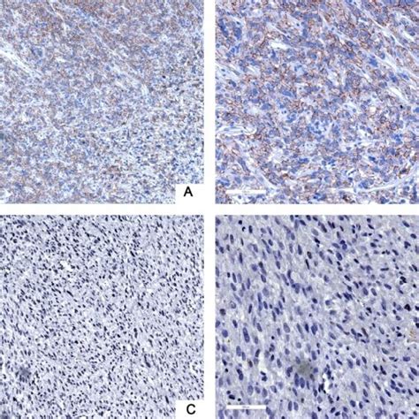 Typical Immunohistochemical Staining Of Pd L1 In Retroperitoneal
