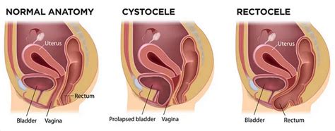 Breaking The Silence Understanding Pelvic Organ Prolapse And How To
