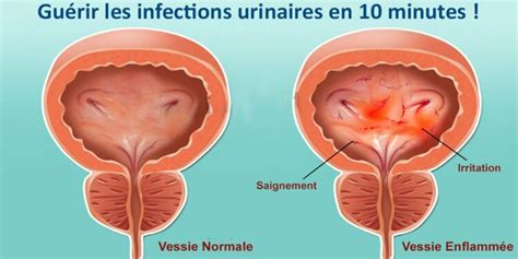 Comment Soigner Une Infection Urinaire En 10 Minutes – Planetefemmes
