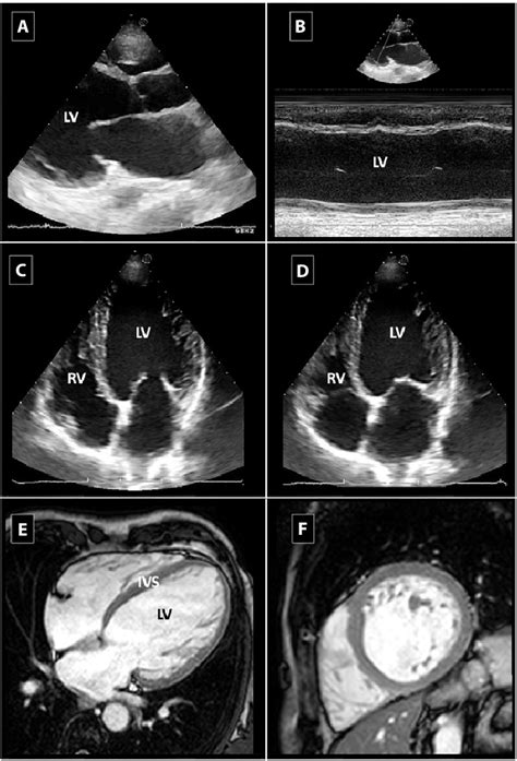 Dilated Cardiomyopathy Echocardiographic And Cardiac Magnetic