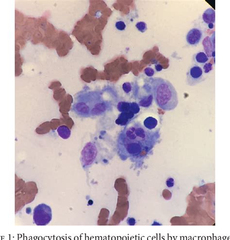 [pdf] A Rare Case Of Hhv 8 Associated Hemophagocytic