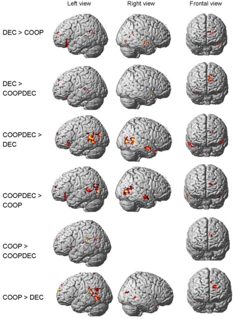 Activation Patterns Are Rendered On The Brain Surface In The Contrasts