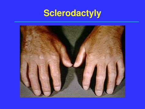 Ppt Scleroderma Powerpoint Presentation Free Download Id 9468576