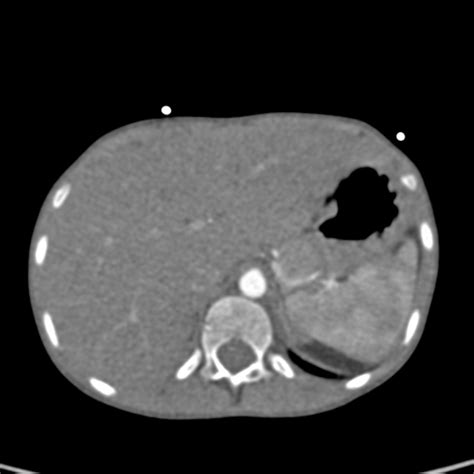File Aortopulmonary Window Interrupted Aortic Arch And Large Pda