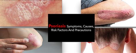 Risk Factors And Precautions For Psoriasis Ask The Nurse Expert
