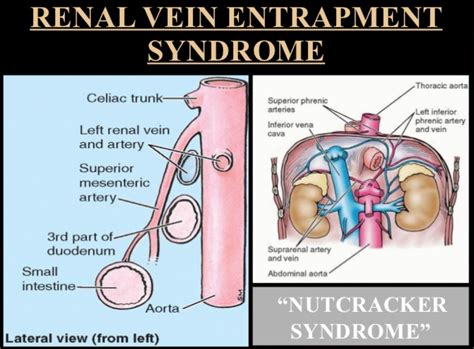 Nutcracker Phenomenon And Syndrome Vascular Care Centre
