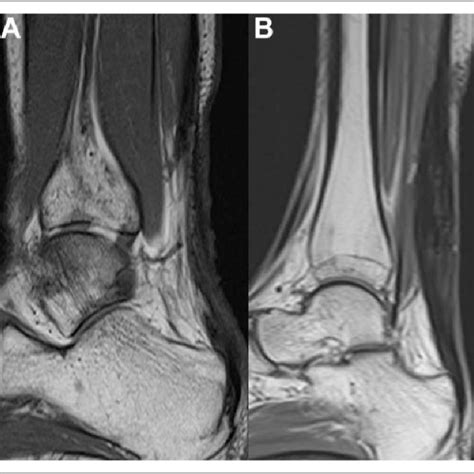 A Preoperative And B Postoperative Magnetic Resonance Image Showing