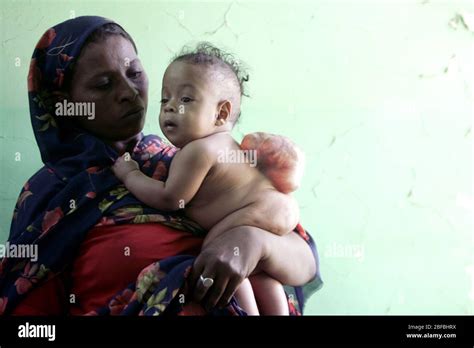 Junge Mit Spina Bifida Fotos Und Bildmaterial In Hoher Auflösung Alamy