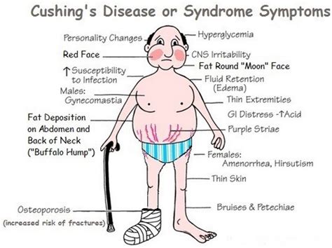 Cushing Syndrome Pictures Medical Pictures And Images 2023 Updated