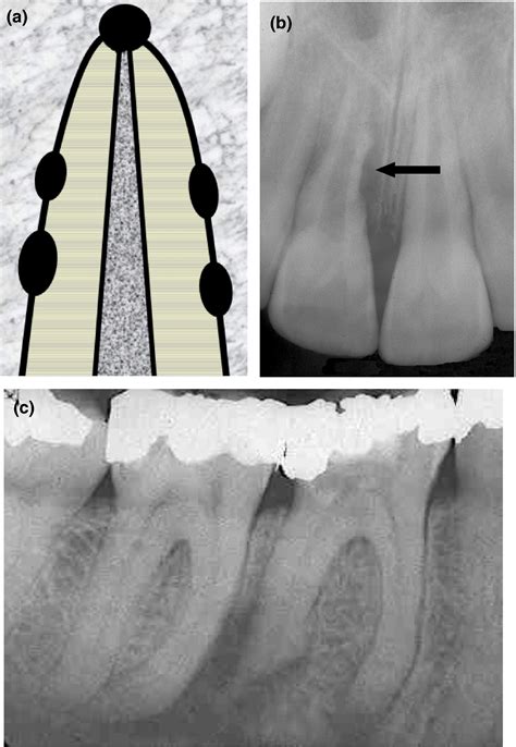 Prevention And Management Of External Inflammatory Resorption Following