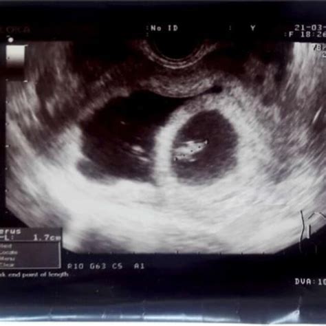 Transvaginal Ultrasound Scan After The Procedure Download Scientific