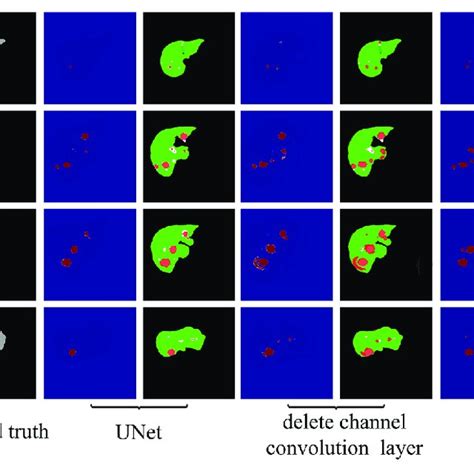Example Of Over Segmentation And Under Segmentation In Liver