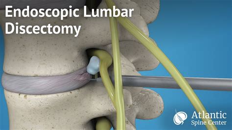 Percutaneous Foraminal Endoscopic Lumbar Discectomy — 55 Off