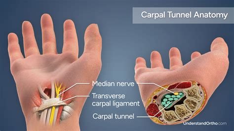 Carpal Tunnel Release Understandortho™