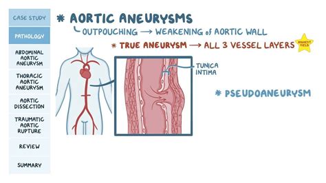 Eltérít Megy Kínvallatás Ebm Aortic Aneurysm And Dissection Beleegyezés