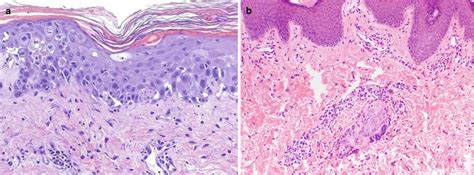 Histopathology Of Cutaneous Graft Versus Host Disease Plastic Surgery Key