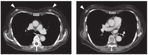 Contrast Enhanced Computed Tomography Ct A Ct Scans Revealed