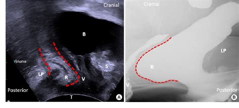 [pdf] Comparison Of 3 Dimensional Pelvic Floor Ultrasonography And