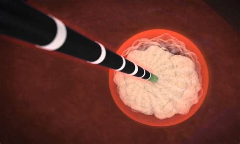 Interventional Oncology – Interventional Oncology News And Education