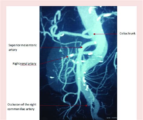 Reconstruction Of Aortic Ct Scan Showed Different Branches Of The Aorta