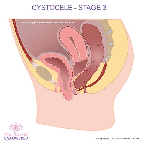 Prolapsed Bladder Stage 2