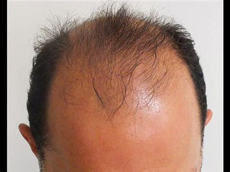 Dr Ekrem Civas Hair Transplant Forum Result Hair Transplant Forum