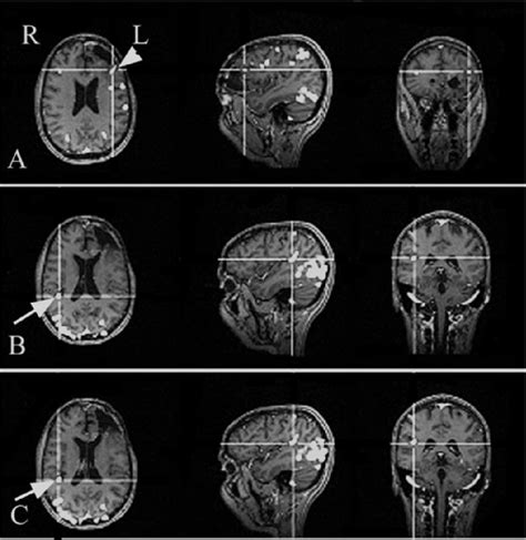 Preoperative Language Functional Magnetic Resonance Mr Imaging Panel