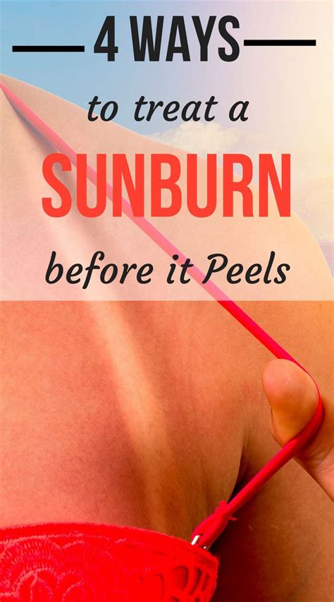 4 Ways To Treat A Sunburn Before It Peels So You Can Keep Your Tan