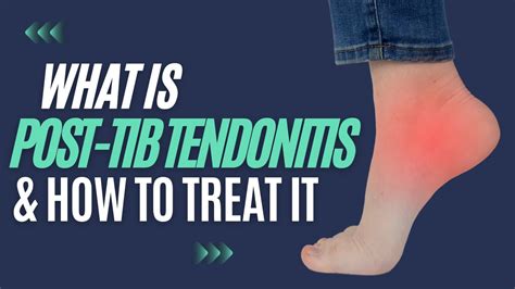 Posterior Tibial Tendonitis What Is It And How Do You Treat It Youtube
