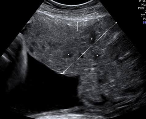 Placenta Accreta Spectrum Obstetrics And Gynecology Clinics